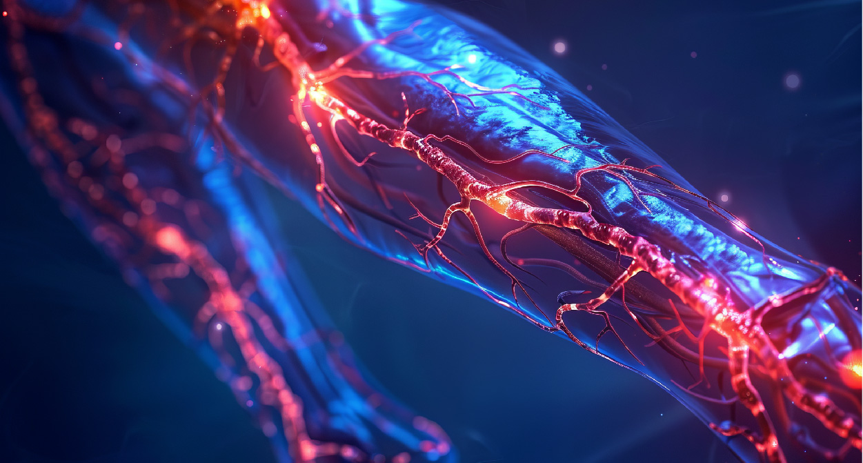 Impact of lymphedema in the management of venous leg ulcers | Avalere ...